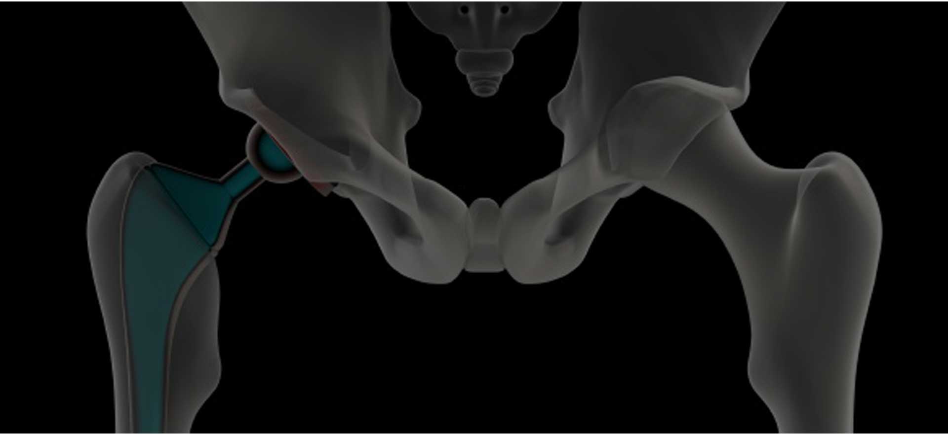 Experienced Defective Hip Lawyer | Depuy, Stryker